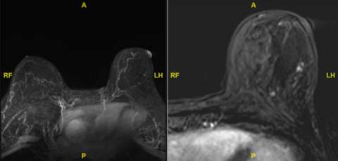 Skin Changes of the Breast - Radiology | UCLA Health