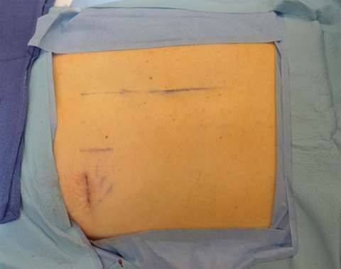 Adrenal Surgery: What is Adrenalectomy? - Endocrine Surgery | UCLA Health