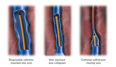 The Closure Procedure and Catheter - Venous Care | UCLA Health