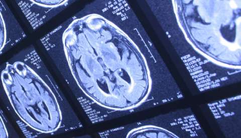 Epilepsy Care: The Danger of the Unknown - Neurology | UCLA Health