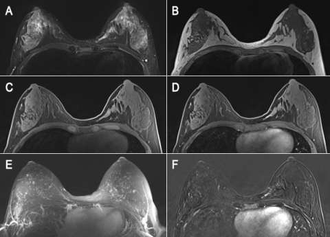 Breast MRI Indications - Radiology | UCLA Health