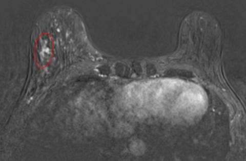 Breast MRI Findings: Non Mass Enhancement (NME) - Radiology | UCLA Health