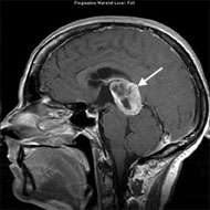 Pineocytoma - Neurosurgery | UCLA Health