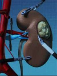 Kidney Cancer Treatment | UCLA Health Jonsson Comprehensive Cancer Center