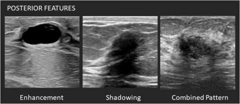 Ultrasound: Masses - Radiology | UCLA Health