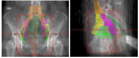 External Beam Radiation Therapy (EBRT) - Radiation Oncology | UCLA Health