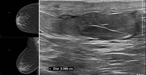 Skin Changes of the Breast - Radiology | UCLA Health