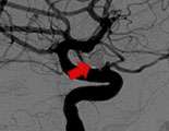 Coil Embolization: Treating Aneurysm - Radiology | UCLA Health