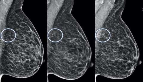 Breast Asymmetry - Radiology | UCLA Health