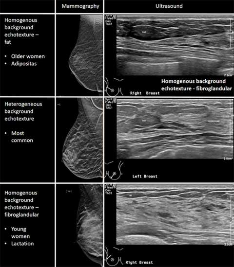 Basics of Breast Ultrasound - Radiology | UCLA Health
