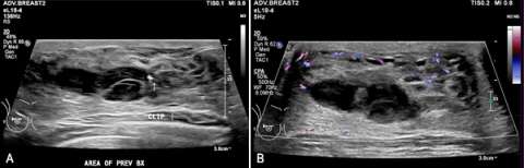 Seromas and Hematomas in the Breast - Radiology | UCLA Health