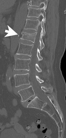 Vertebroplasty / Kyphoplasty / Sacroplasty - Interventional ...