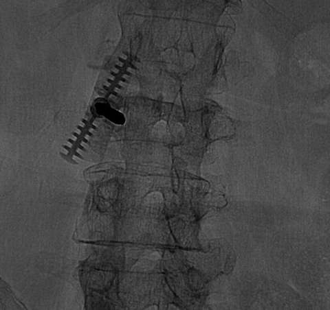Vertebroplasty / Kyphoplasty / Sacroplasty - Interventional ...