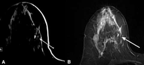 Case: Fibroadenomas Tumors - Radiology | UCLA Health
