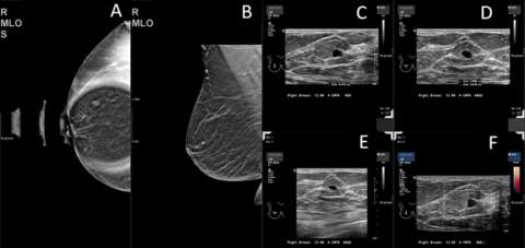 Case Metastasis to the breast from a non-breast primary cancer ...