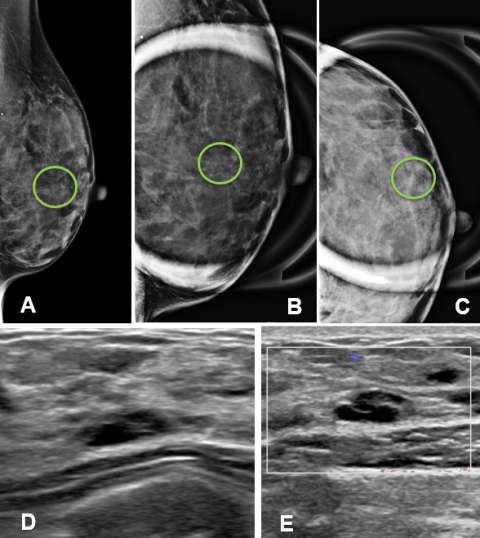 Simple Cyst, Clustered Microcysts, Complicated Cyst - Radiology | UCLA ...