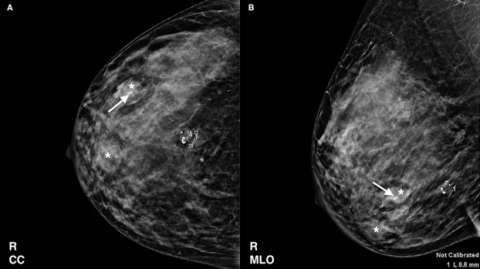 Case: Fibroadenomas Tumors - Radiology | UCLA Health