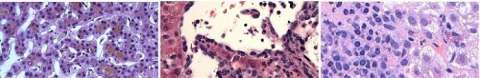 Hepatobiliary Pathology - Pathology | UCLA Health