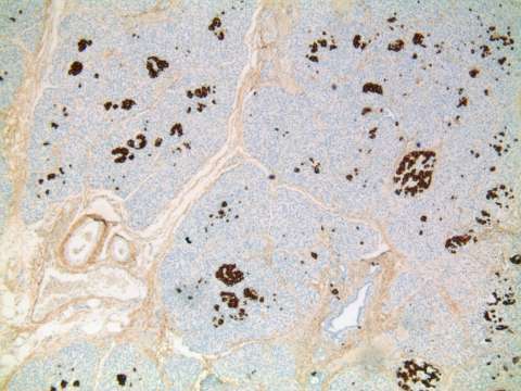 Hyperinsulinism - Pediatric Endocrinology | UCLA Health