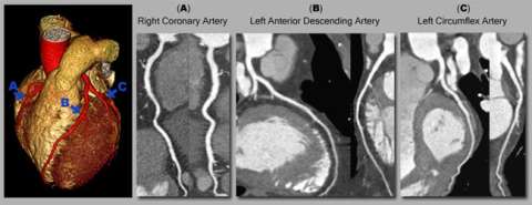 Coronary CTA - Radiology | UCLA Health