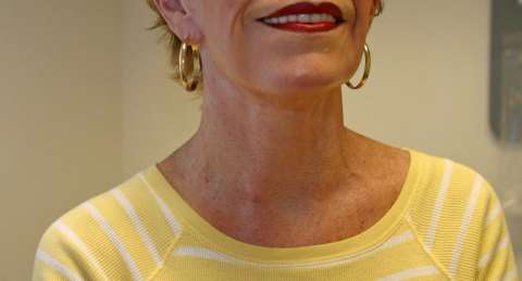 Parathyroidectomy Scar Photos - Parathyroid Surgery Scar Photos ...