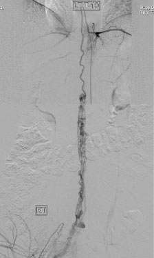 Spinal Vascular Malformation - Interventional Neuroradiology | UCLA Health
