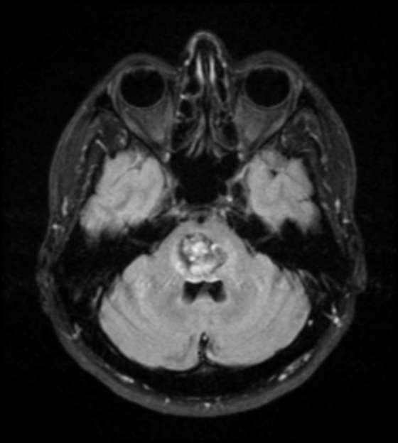 Cavernous Angioma - Neurosurgery | UCLA Health