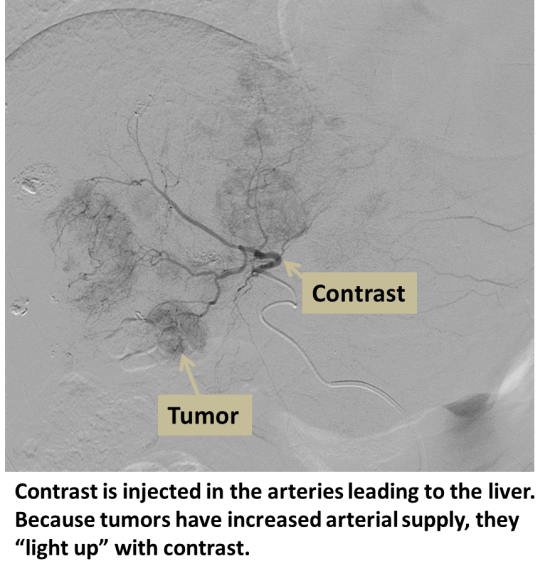 Chemoembolization - Interventional Radiology | UCLA Health