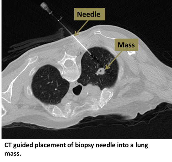 Lung Biopsy - Interventional Radiology | UCLA Health