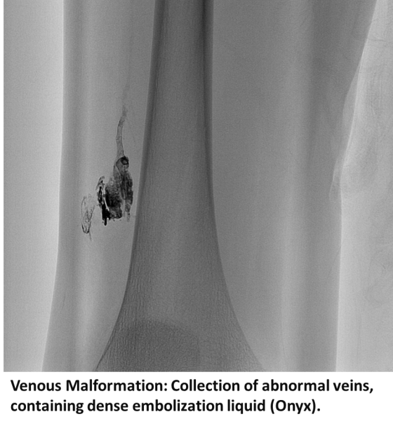 Venous and Lymphatic Malformations - Interventional Radiology | UCLA Health