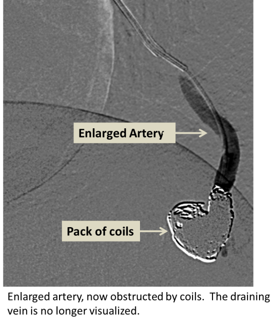 Pulmonary Arteriovenous Malformations (AVM) - Interventional Radiology ...