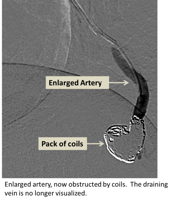 Pulmonary Arteriovenous Malformations (AVM) - Interventional Radiology ...