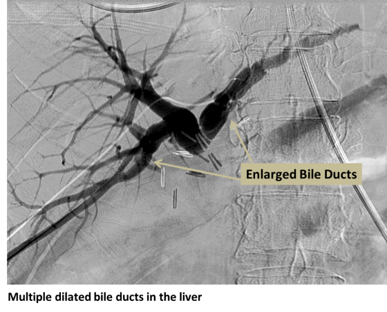 Biliary Obstruction - Interventional Radiology | UCLA Health