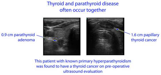Thyroid and Parathyroid Disease - Endocrine Surgery | UCLA Health