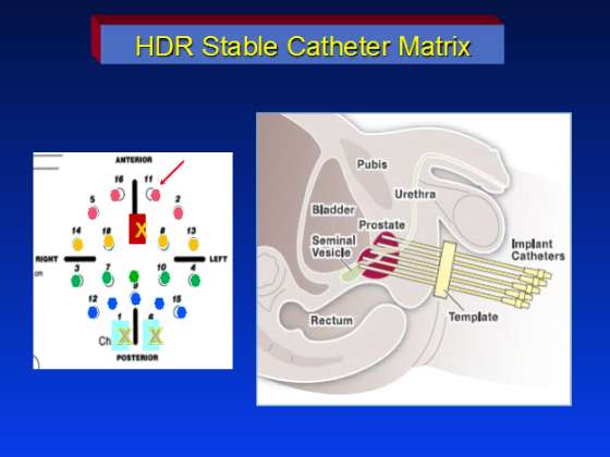 Prostate Cancer – Brachytherapy | UCLA Health Jonsson Comprehensive ...