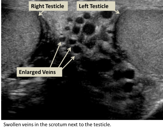 Varicocele - Interventional Radiology | UCLA Health