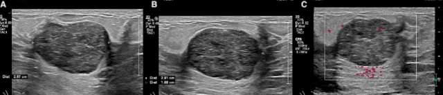 Case: Fibroadenomas and Phyllodes Tumors - Radiology | UCLA Health