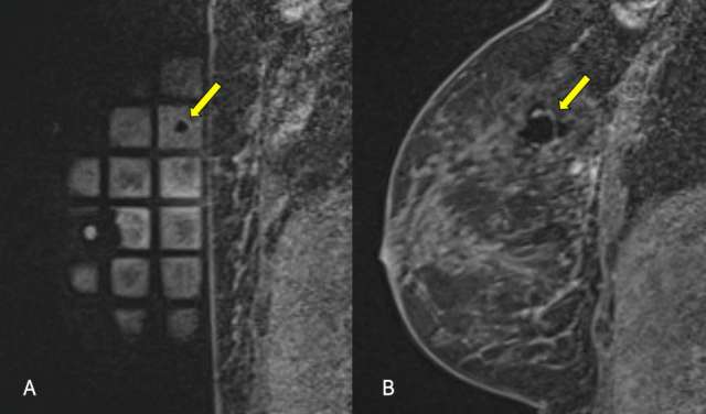 How to Perform an MRI Guided Breast Biopsy - Radiology | UCLA Health