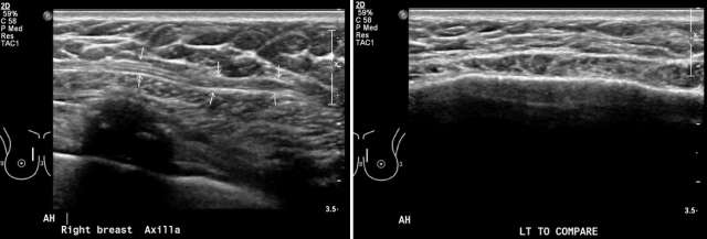 Case: Sternalis Muscle - Radiology | UCLA Health