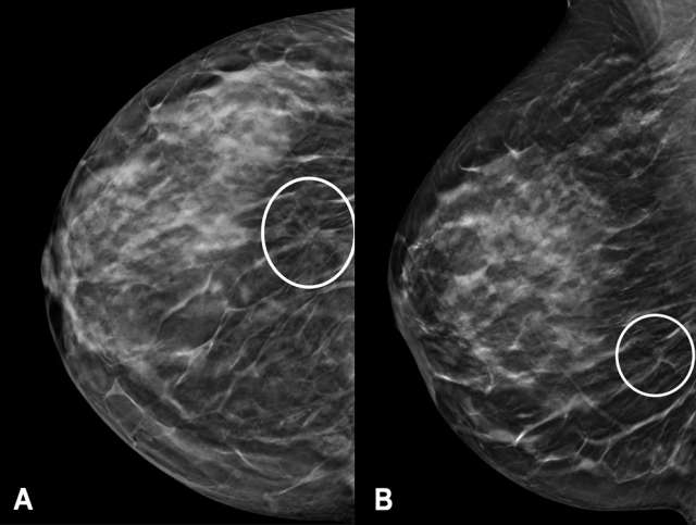 Case: Architectural Distortion - Radiology | UCLA Health