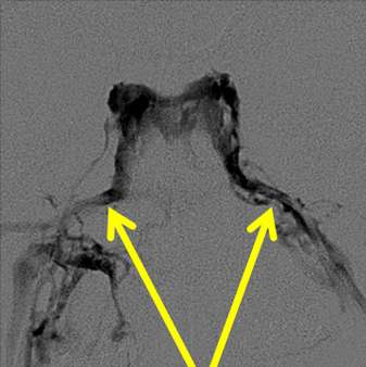 Inferior Petrosal Sinus Sampling - Interventional Neuroradiology | UCLA ...