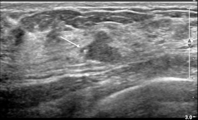 Ultrasound: Calcifications - Radiology | UCLA Health