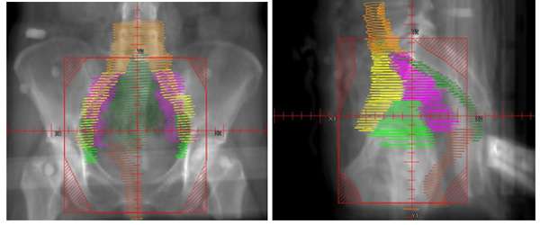 External Beam Radiation Therapy (EBRT) - Radiation Oncology | UCLA Health
