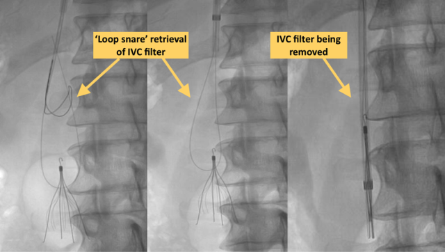 Advanced Removal Techniques - IVC Filter | UCLA Health