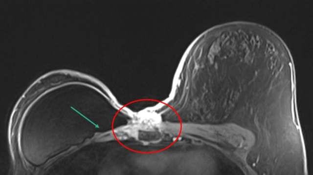 Case: Chest Wall Invasion - Radiology | UCLA Health