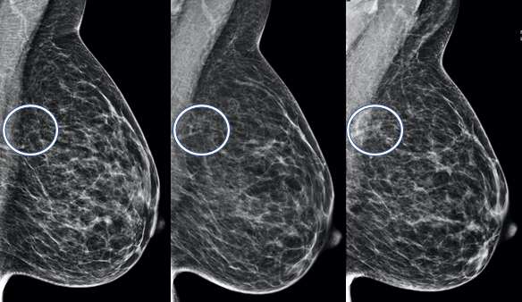 Breast Asymmetry - Radiology | UCLA Health