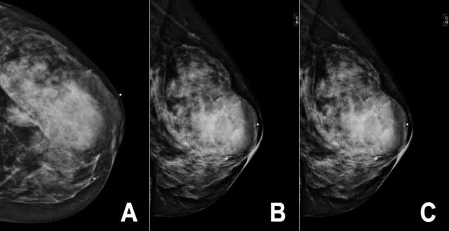 Case: Sarcoma - Radiology | UCLA Health