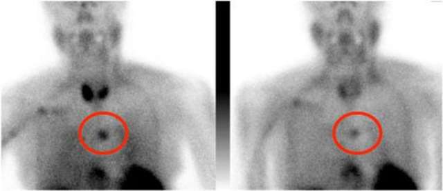 Parathyroid CT Scan Versus Nuclear Medicine Scan: Video - Endocrine ...