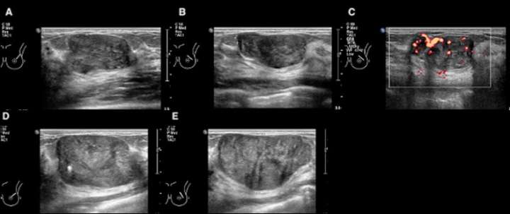 Case: Phyllodes Tumors - Radiology | UCLA Health