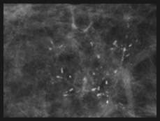 Mammography: Calcifications - Radiology | UCLA Health